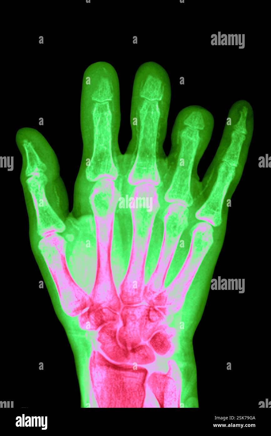 Coloured X-ray (top view) of the hand in a 40 year old female patient ...