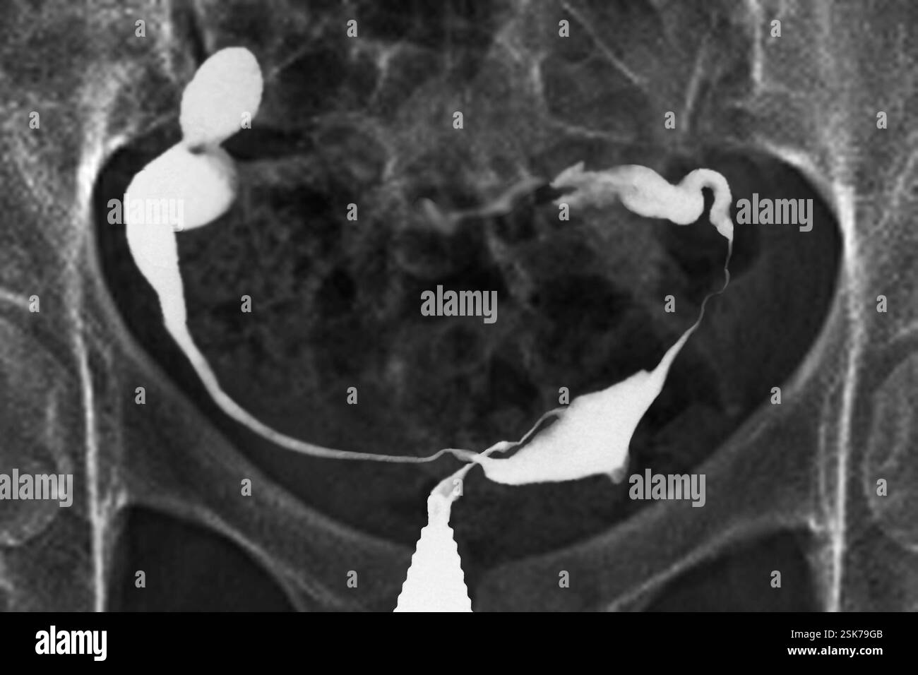 Hysterosalpingogram (front view) of the lower abdomen in a 27 year old ...