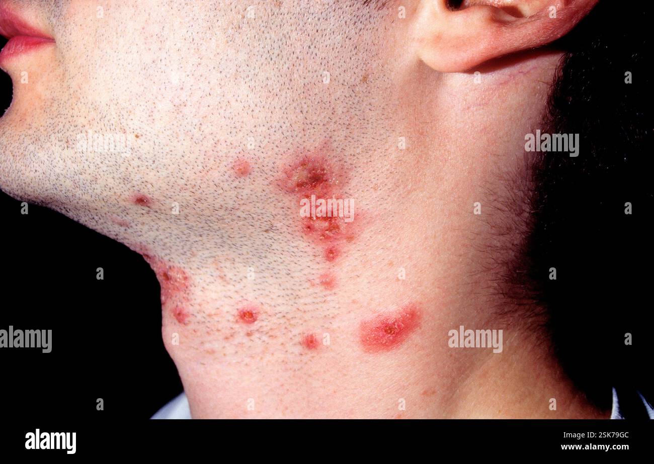 Shingles rash of blisters on the skin of the neck in a male patient ...