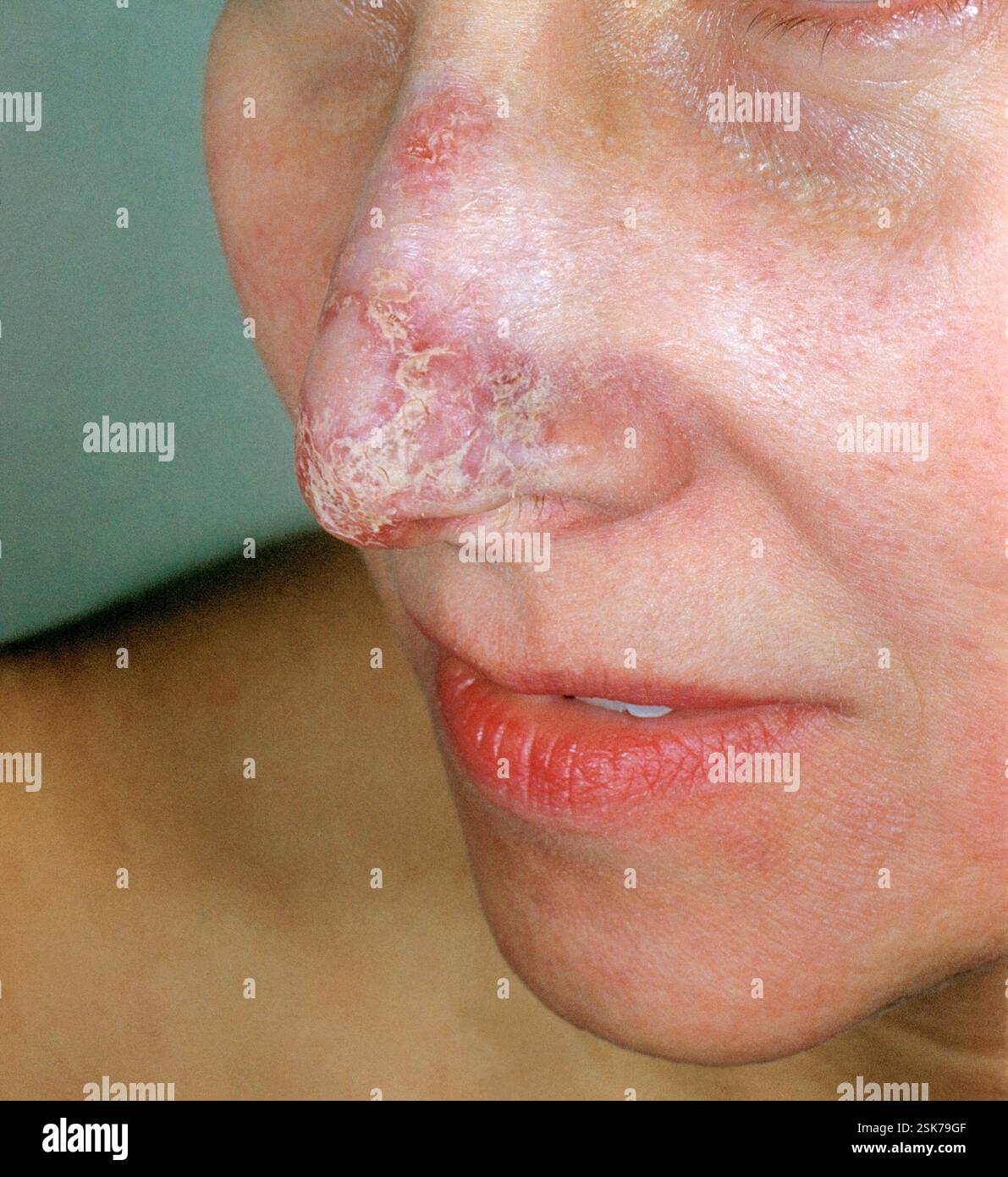 Systemic lupus erythematosus (SLE) rash on the skin of the nose in a ...