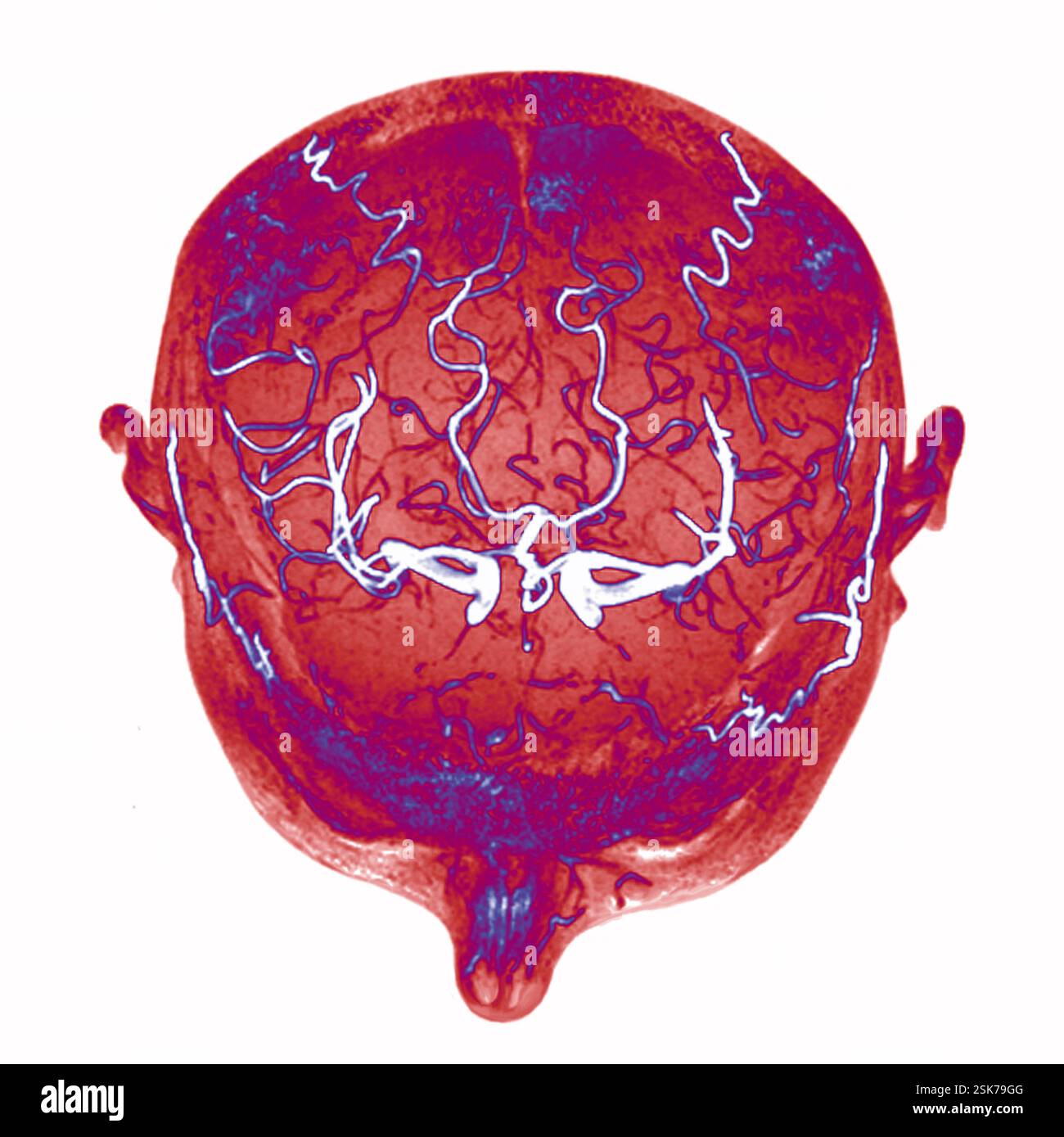 Coloured three-dimensional (3D) Magnetic Resonance Imaging (MRI) scan in top view of healthy ...