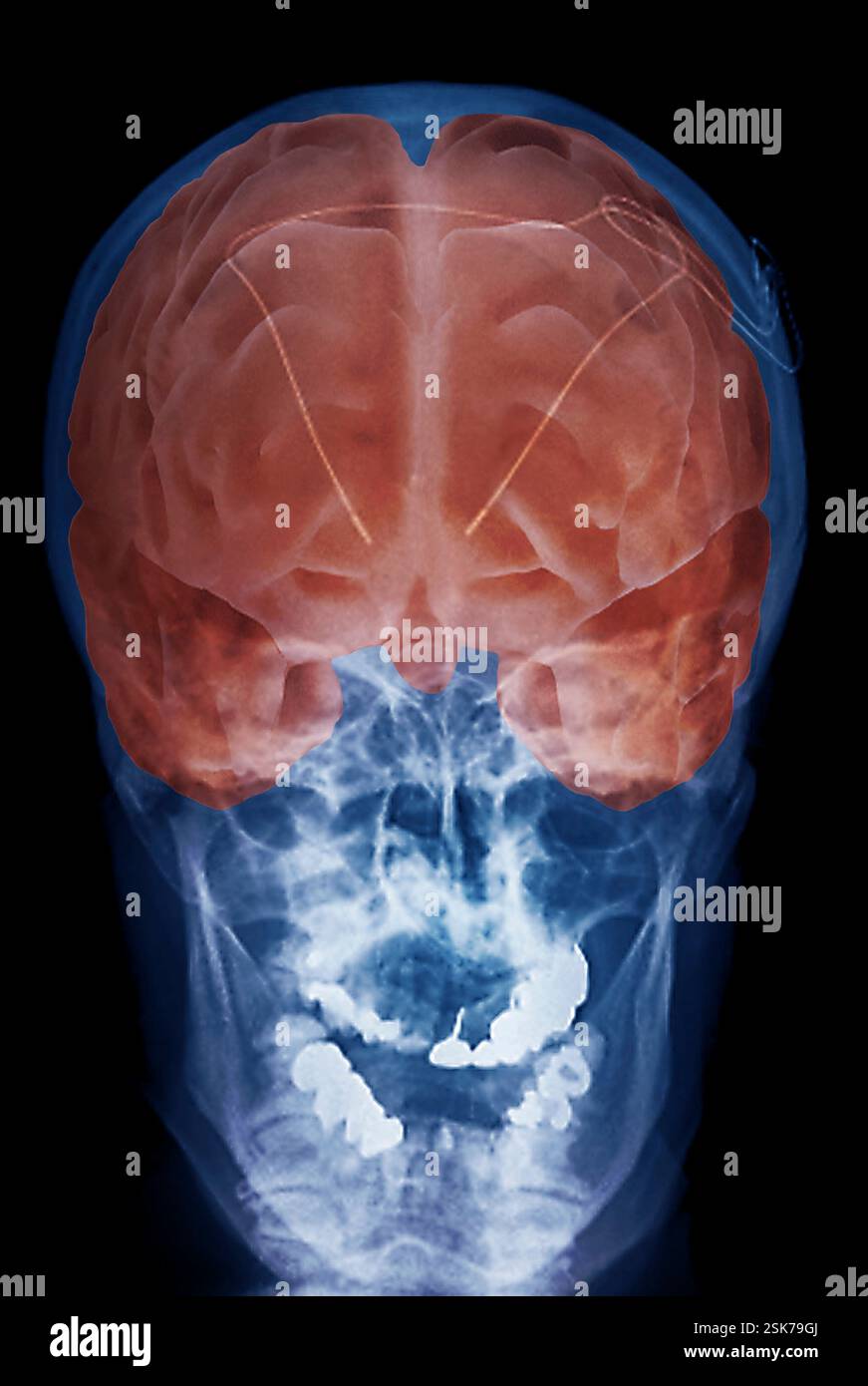 Coloured three-dimensional (3D) Magnetic Resonance Imaging (MRI) scan in front view of the brain ...