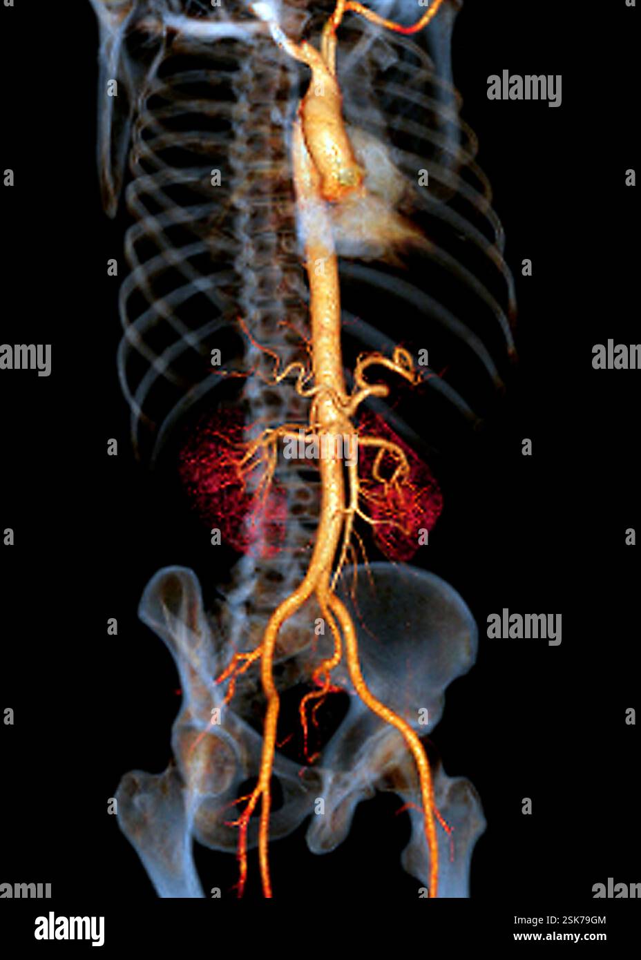 Coloured three-dimensional (3D) Angiography Computed Tomography (CT) scan in front view of the ...