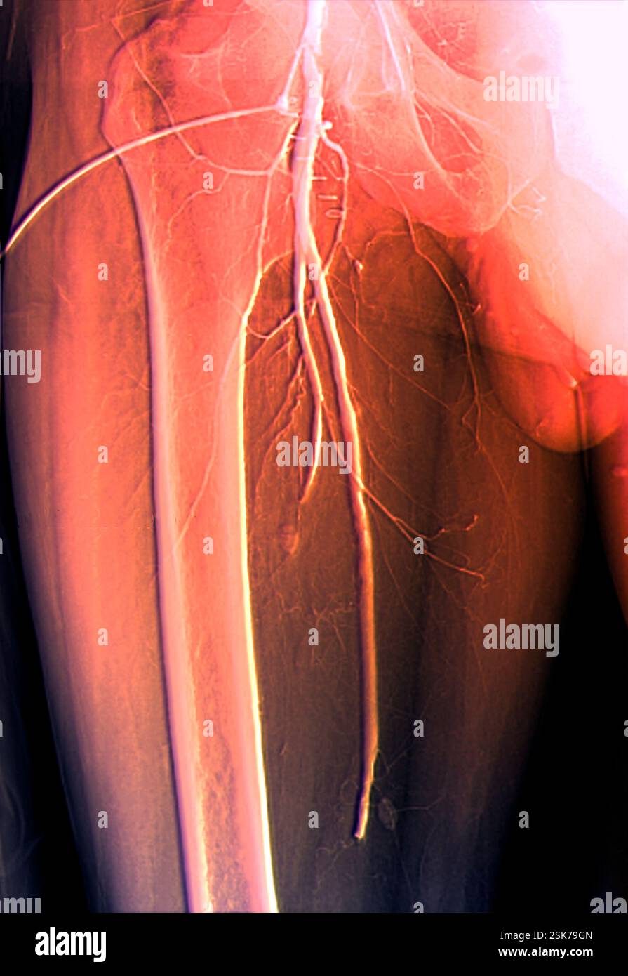 Coloured digital angiogram (X-ray) in front view of the lower limb in a ...