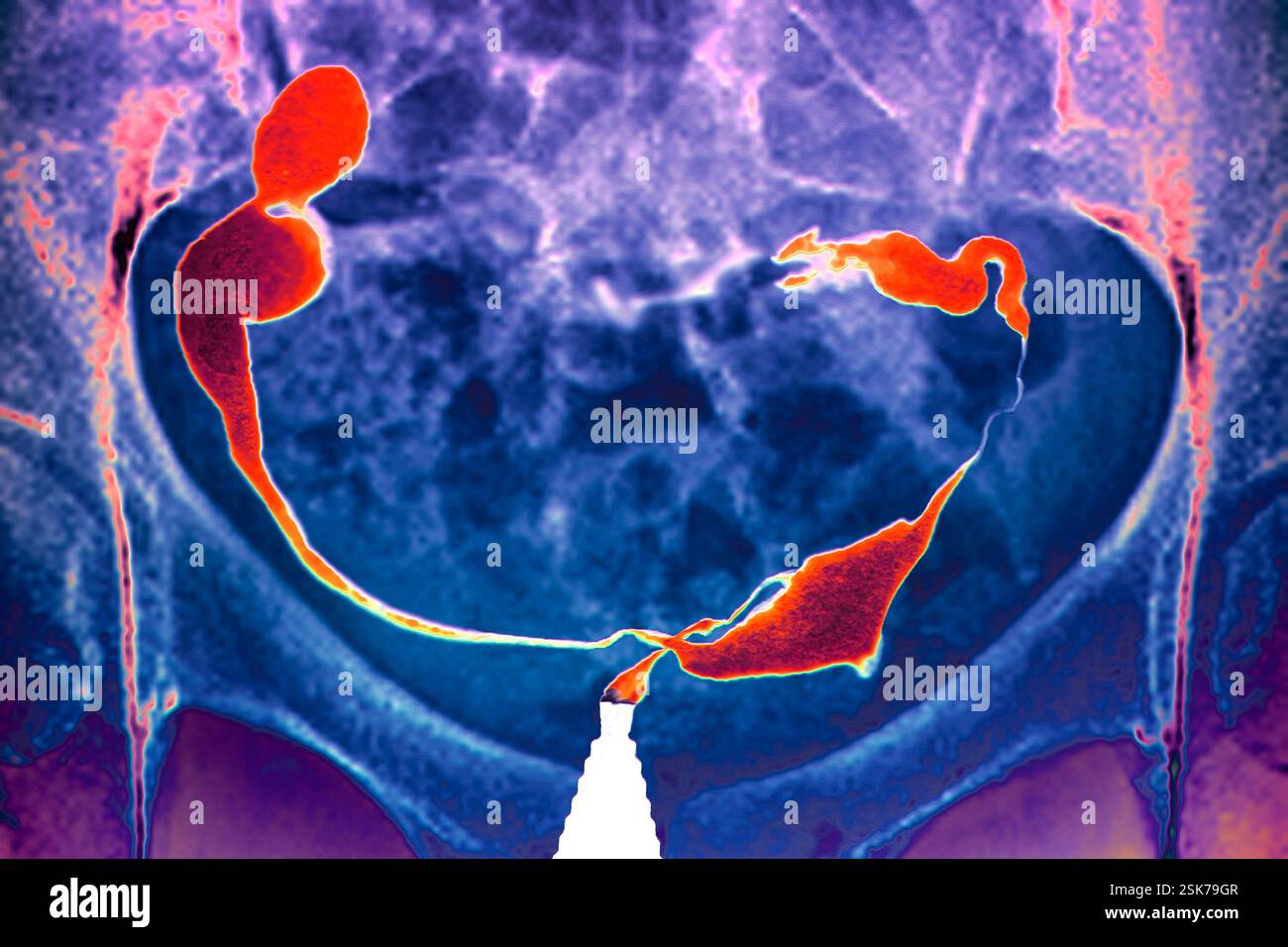Coloured hysterosalpingogram (front view) of the lower abdomen in a 27 ...