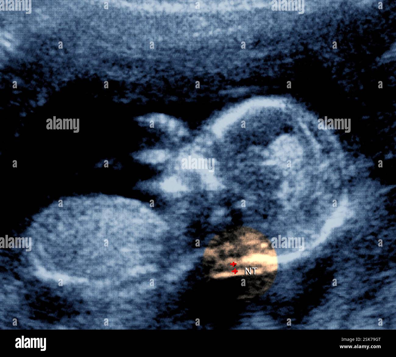 Obstetrical ultrasound scan (sagittal view) of a foetus at 13 weeks and ...