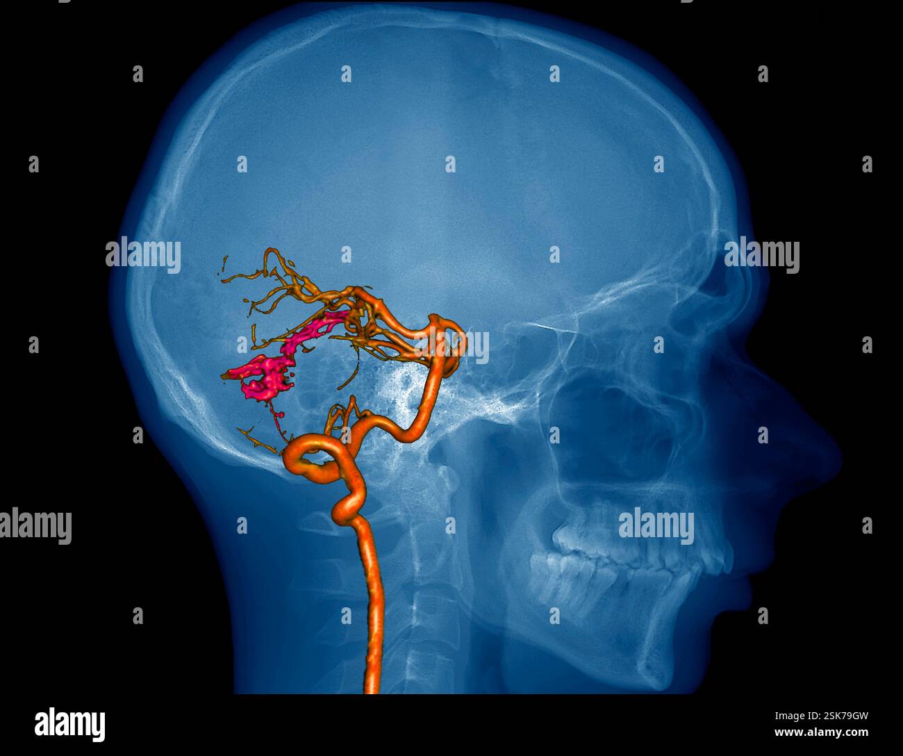 Coloured three-dimensional (3D) Angiography Computed Tomography (CT) scan in side view of a ...