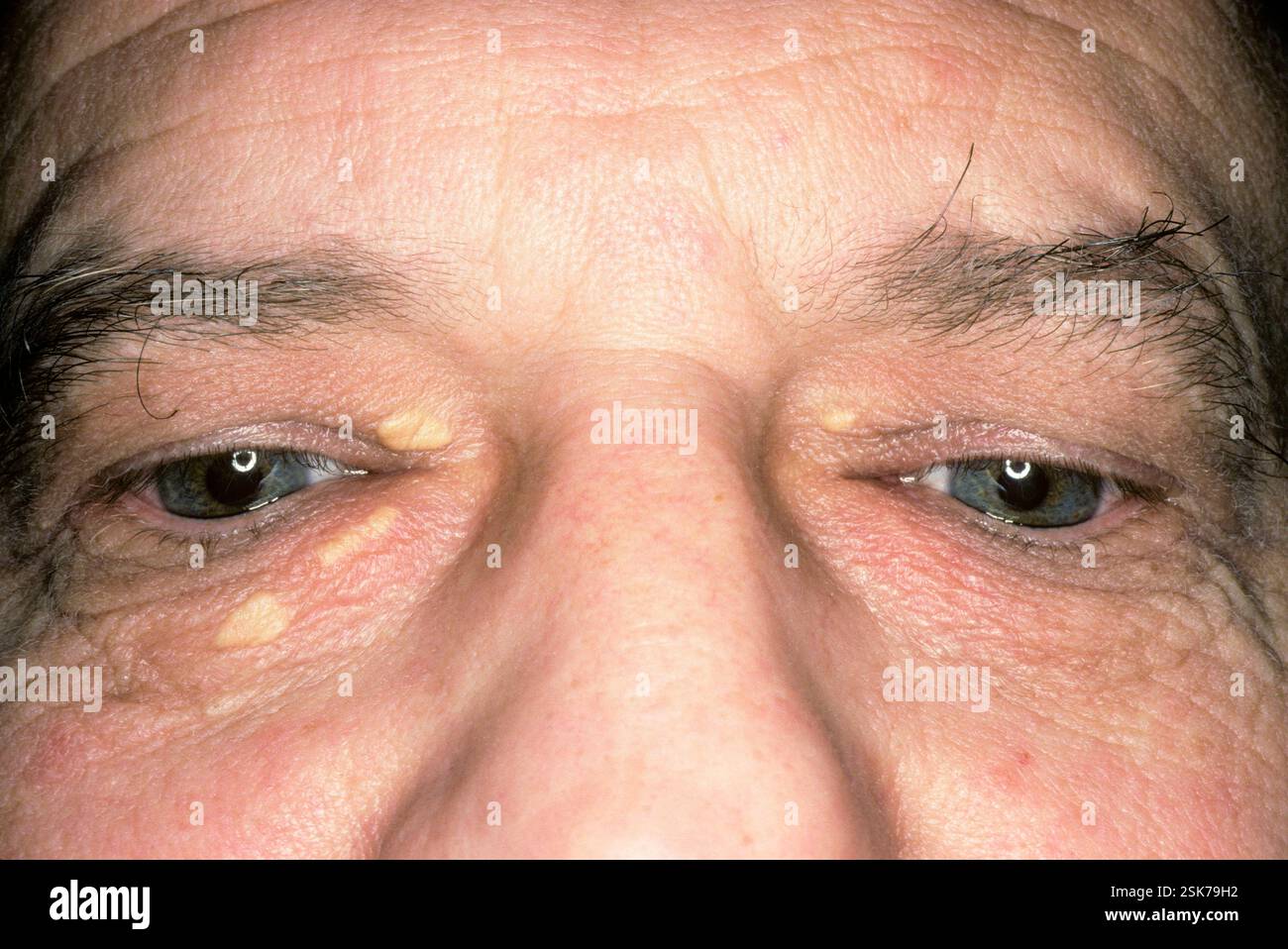 Close-up of fat deposits on the eyelids in a male patient due to a ...