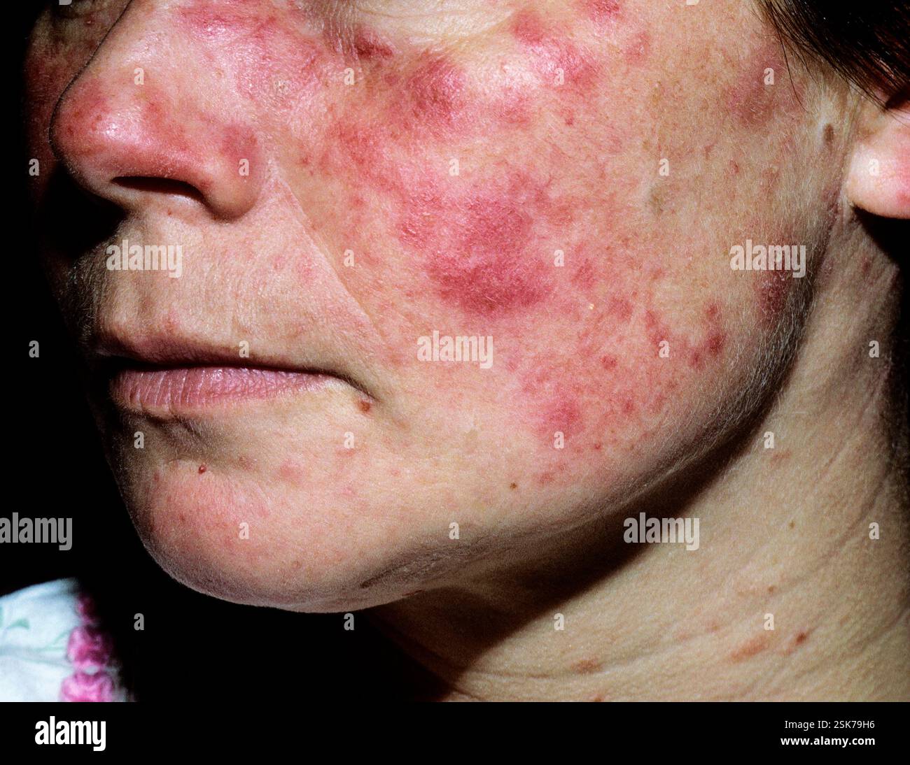 Systemic lupus erythematosus (SLE) rash on the skin of the face in a ...