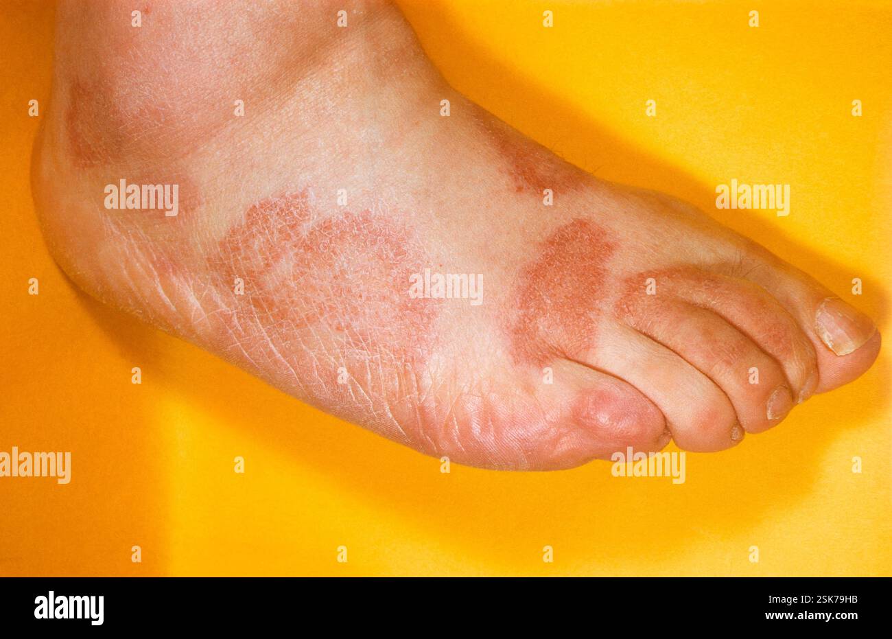 Discoloured skin of the foot in a male patient with leprosy (Hansen's ...