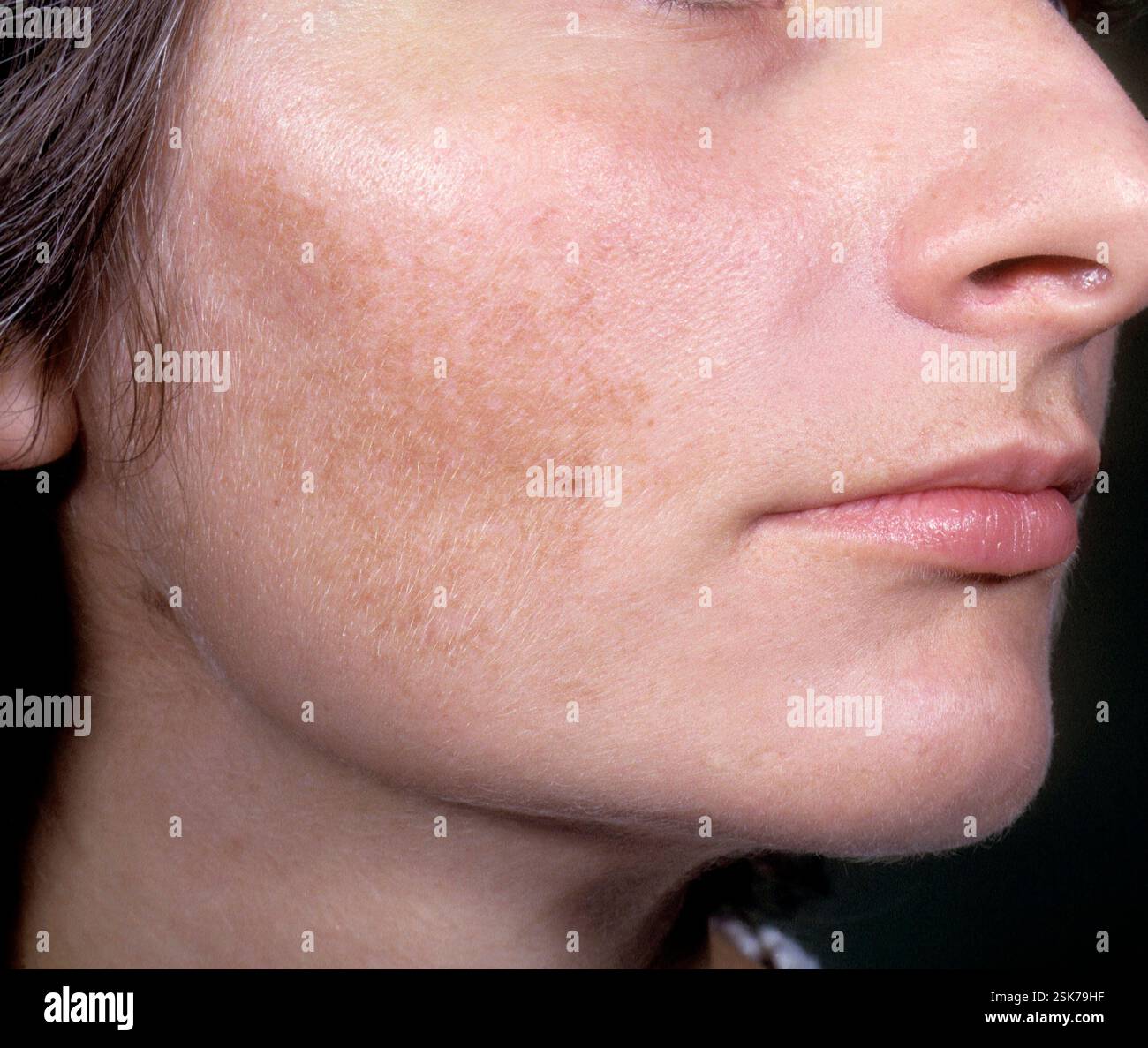 Pale brown skin patch on the cheek of the face in a female patient due ...