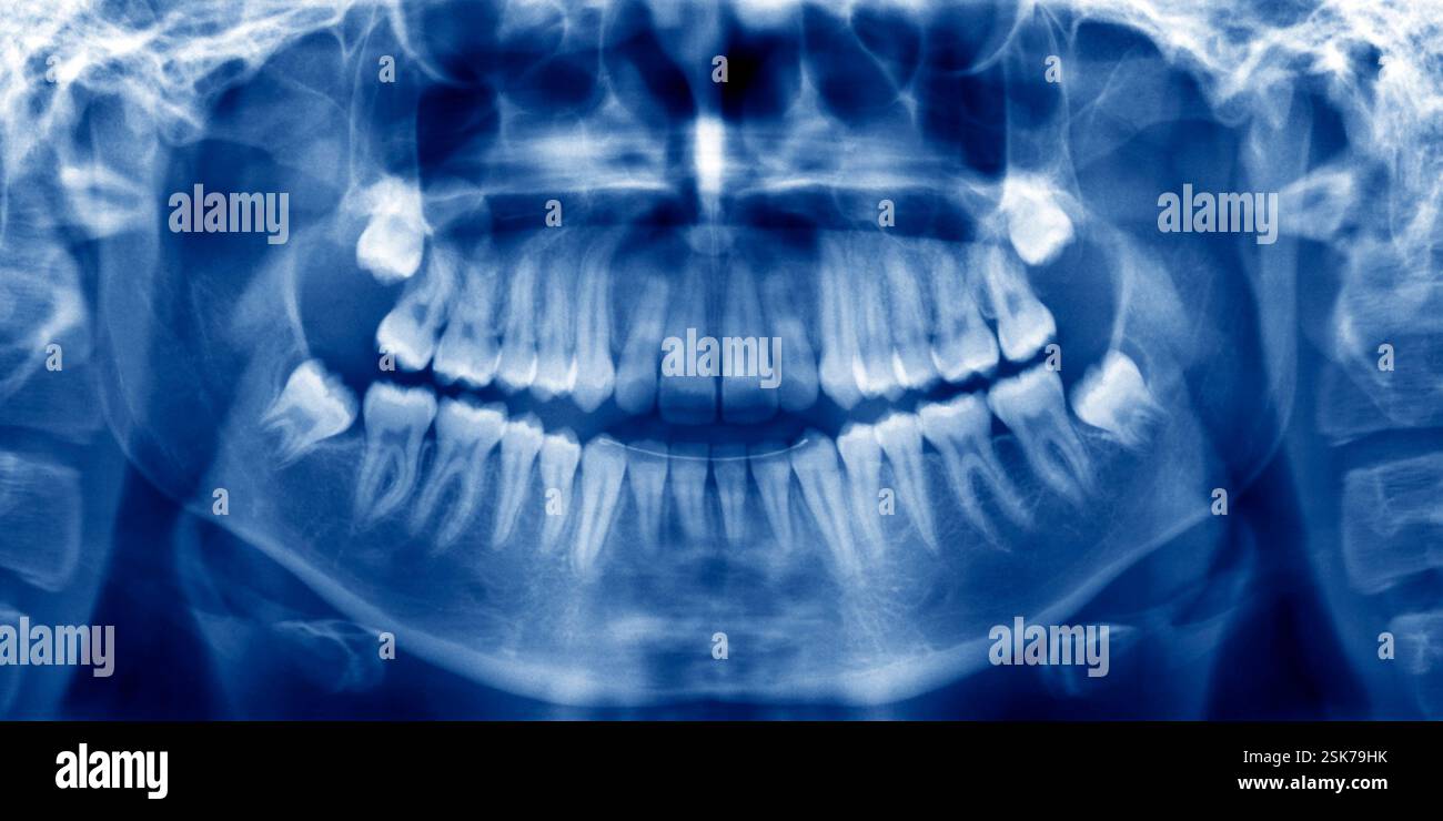 Panoral dental X-ray of the healthy teeth in a 15 year old male patient ...