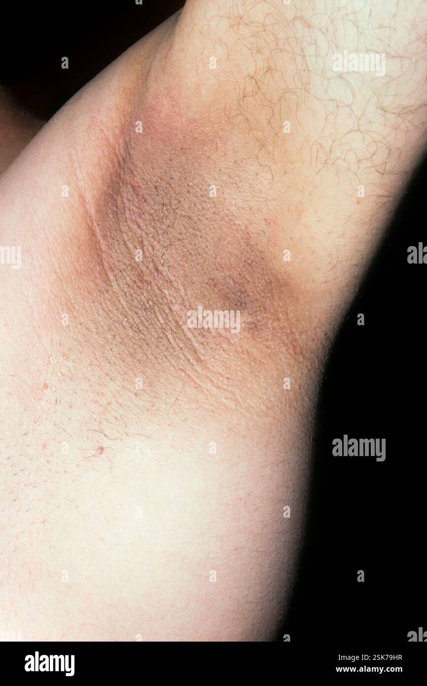 Thickened dark patch of skin in the underarm (axilla) of a male patient ...