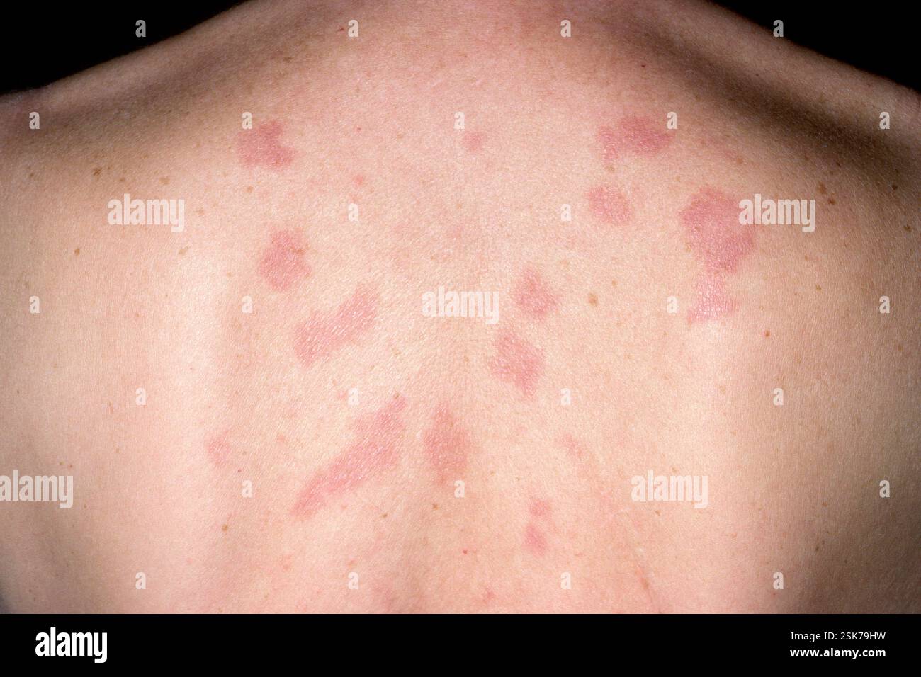 Systemic lupus erythematosus (SLE) rash on the skin of the back in a male patient, an autoimmune ...