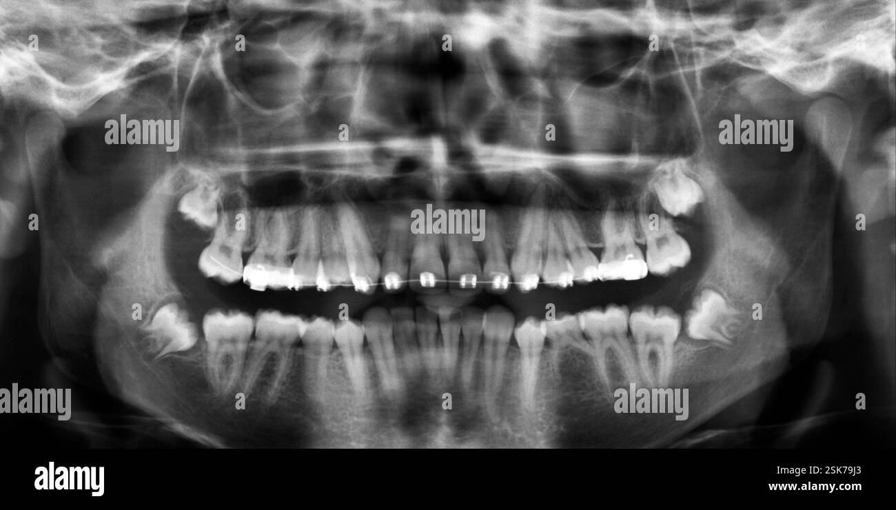 Panoral dental X-ray of the teeth in a 16 year old male patient showing ...