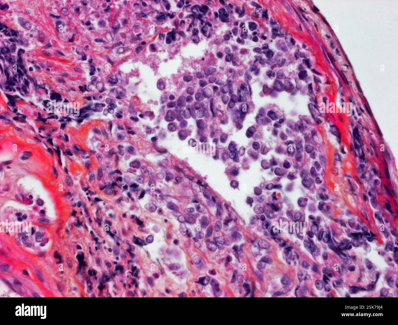 Lung cancer. Light micrograph of a section through lung tissue affected ...