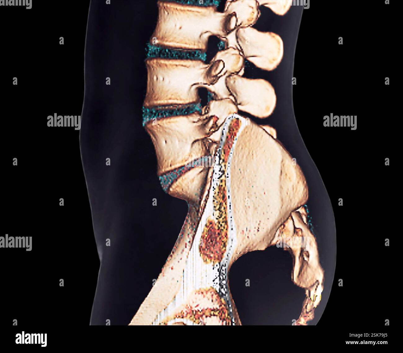Lower spine. Coloured three-dimensional computed tomography (CT) scan ...