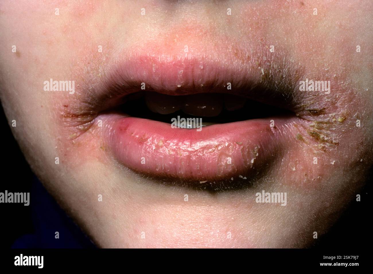 Close-up of skin cracking and splitting at the sides of the mouth in a child, known as angular ...