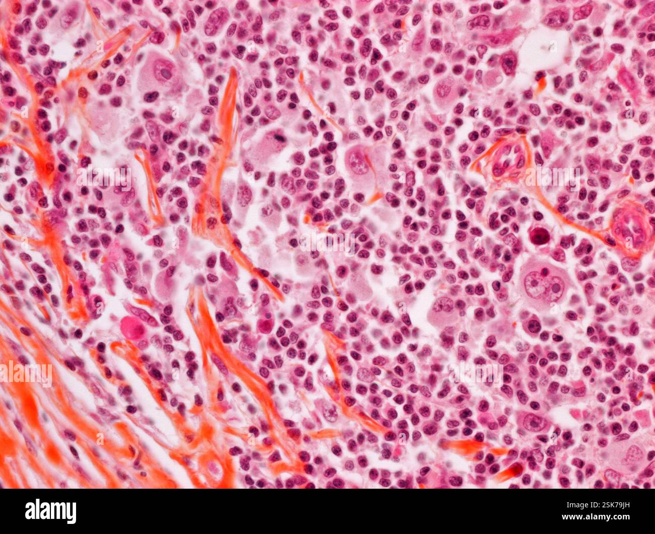 Hodgkin's lymphoma. Light micrograph of a section through a lymph node ...