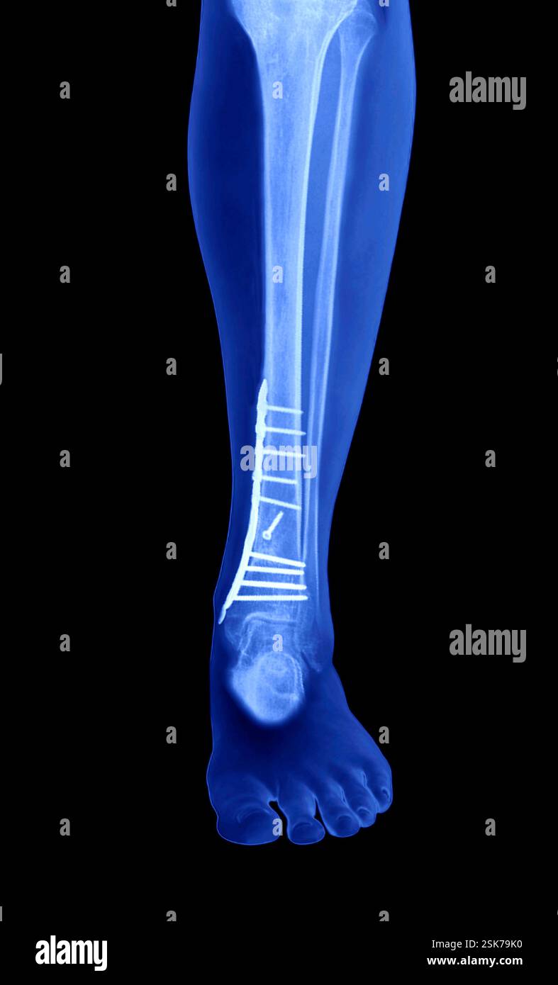 Pinned fractured leg. Coloured X-ray of the lower leg of a 26-year-old ...