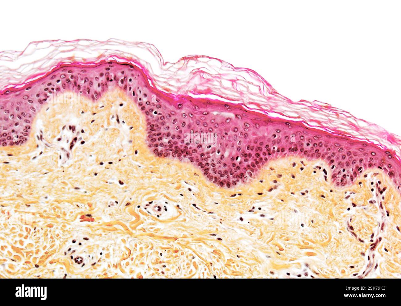 Vitiligo. Light micrograph of a section of human skin with vitiligo ...