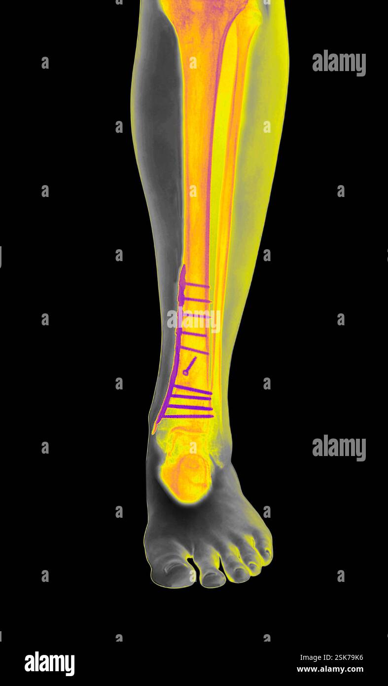 Pinned fractured leg. Coloured X-ray of the lower leg of a 26-year-old ...