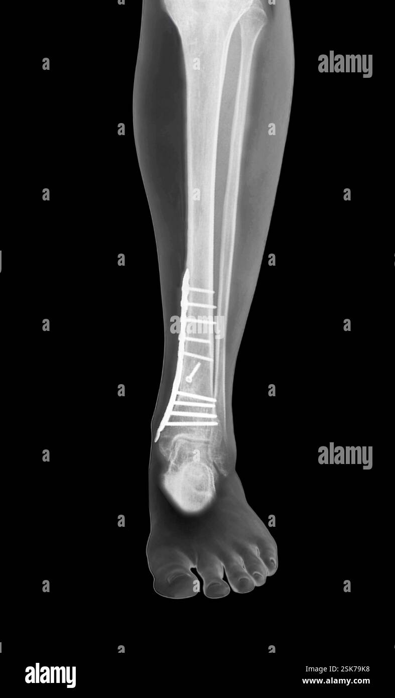 Pinned fractured leg. X-ray of the lower leg of a 26-year-old male ...