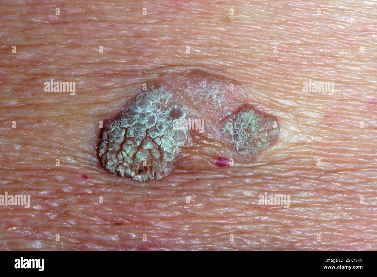 Seborrheic keratosis. Close-up of a seborrheic keratosis (seborrheic or ...