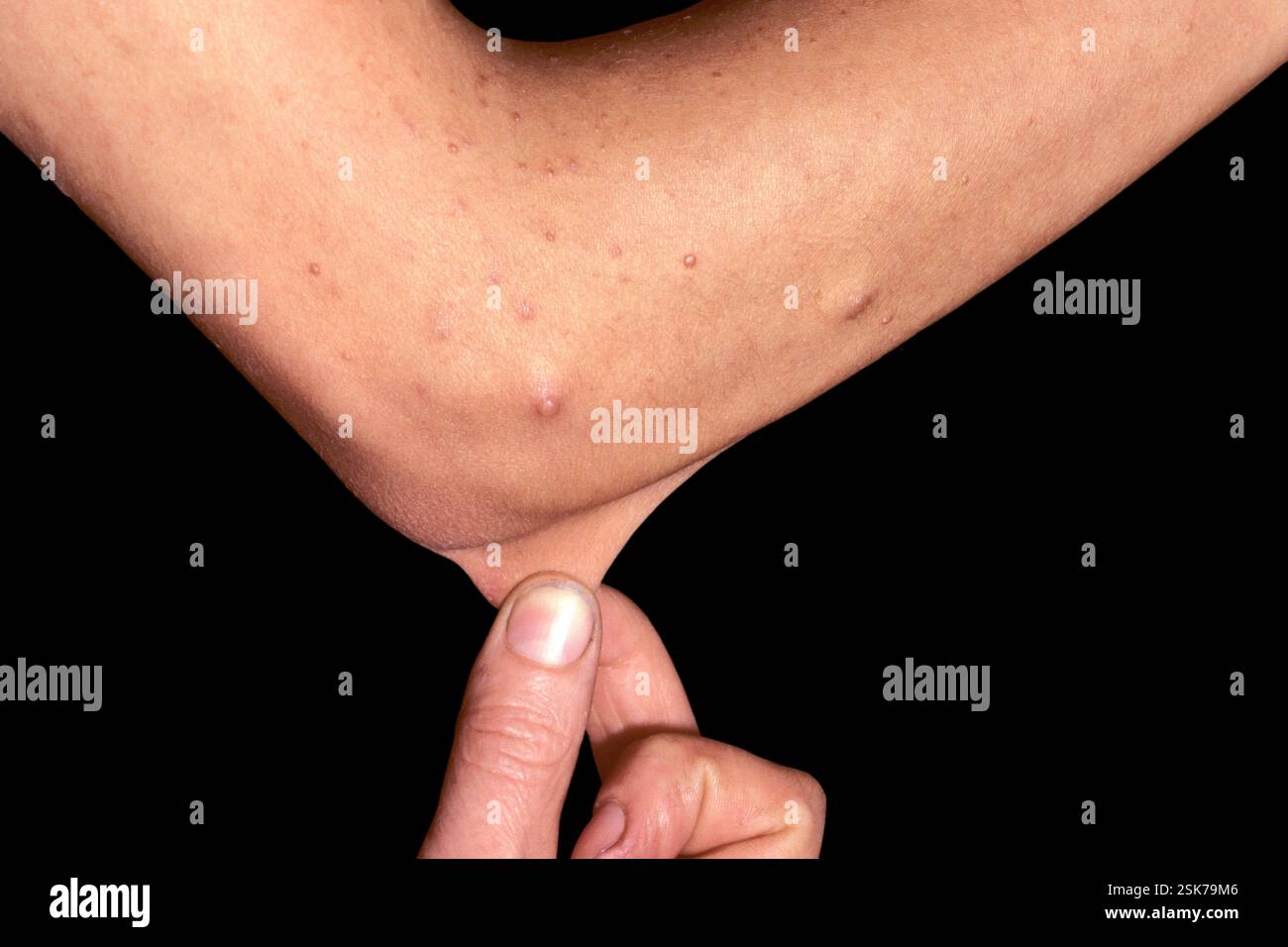 Elastorrhexis. Close-up of the elbow of a 30-year-old female patient ...