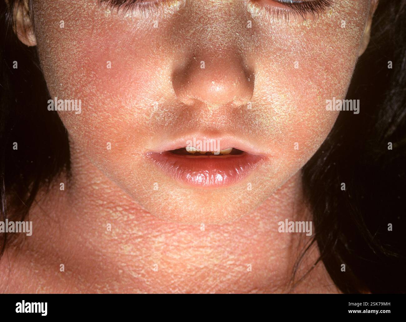 Pityriasis rubra pilaris. Close-up of scaly skin on the face and neck ...
