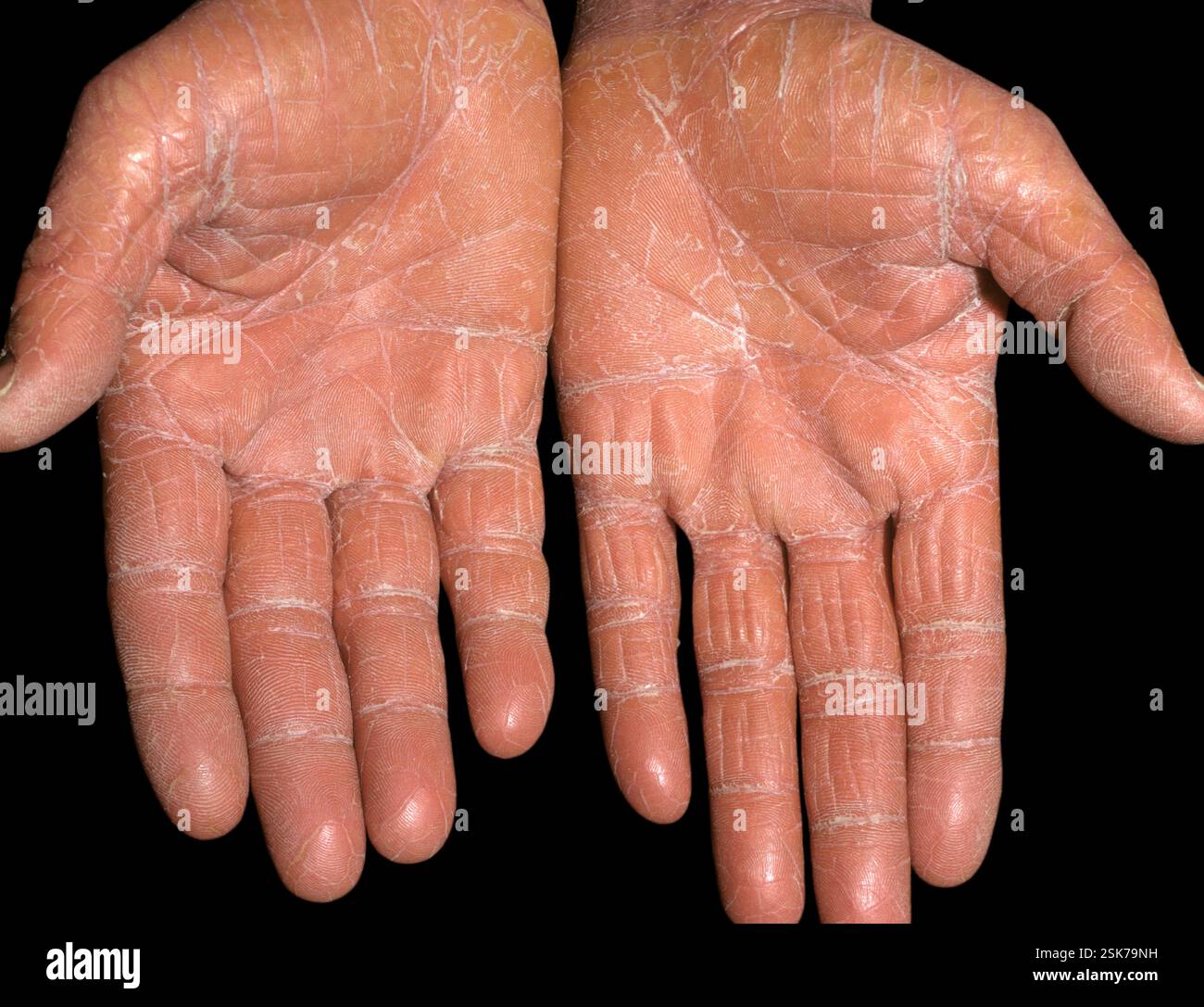 Pityriasis rubra pilaris. Close-up of scaly skin on the hands of a of a ...