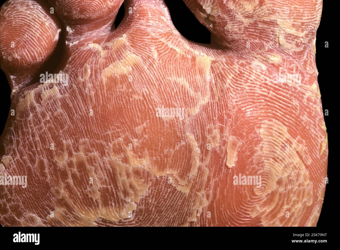Pityriasis rubra pilaris. Close-up of scaly skin on the foot of a of a ...