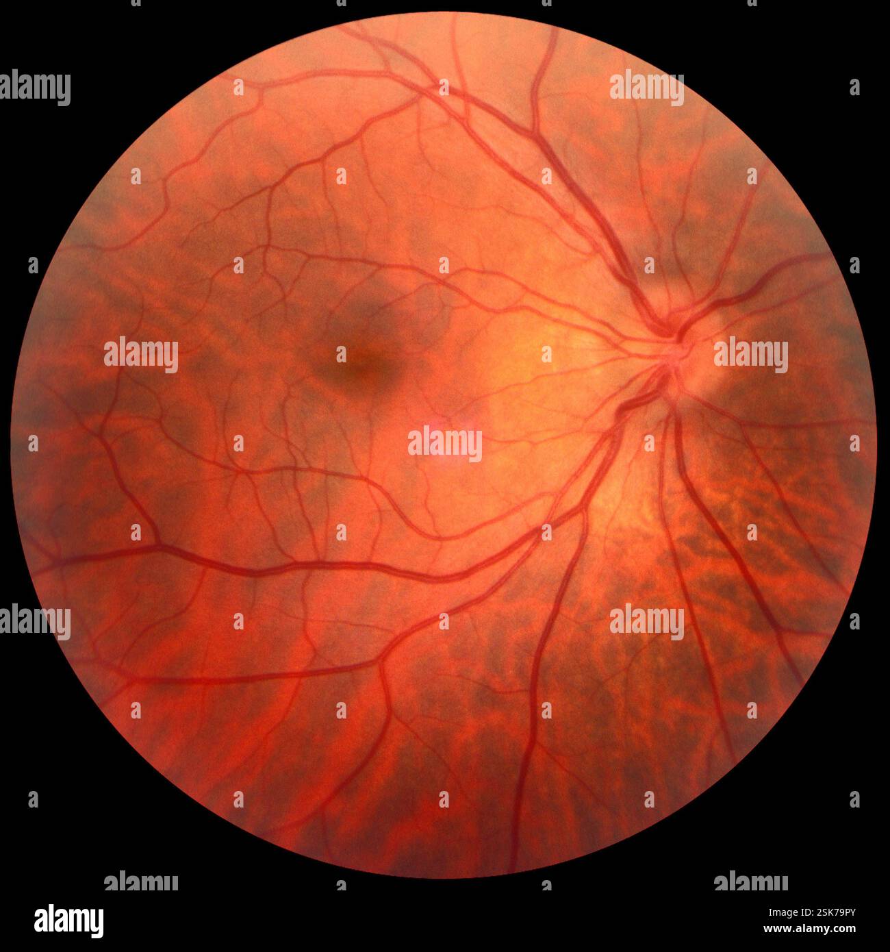 Optic disc drusen. Fundoscopy image of the retina of a patient's eye in ...