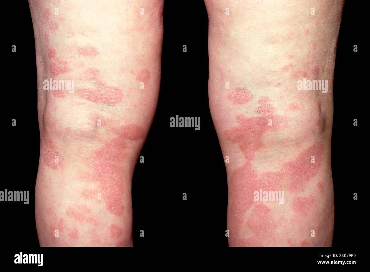 Plaque parapsoriasis. Clinical close-up view of lesions on the legs of ...