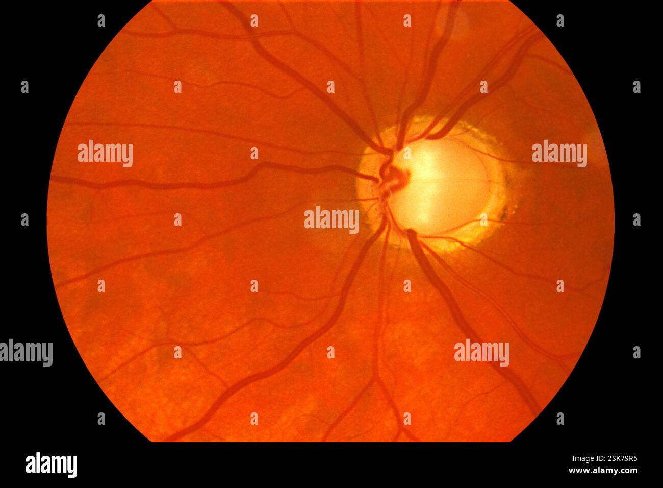 Glaucoma. Fundoscopy image of the retina of a patient's left eye in a ...