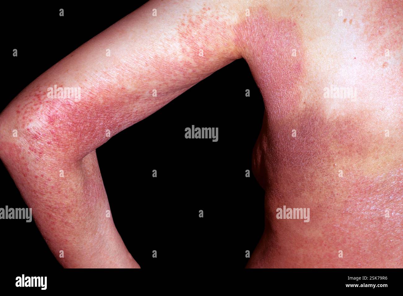 Plaque parapsoriasis. Clinical view of lesions on the arm and back of a ...