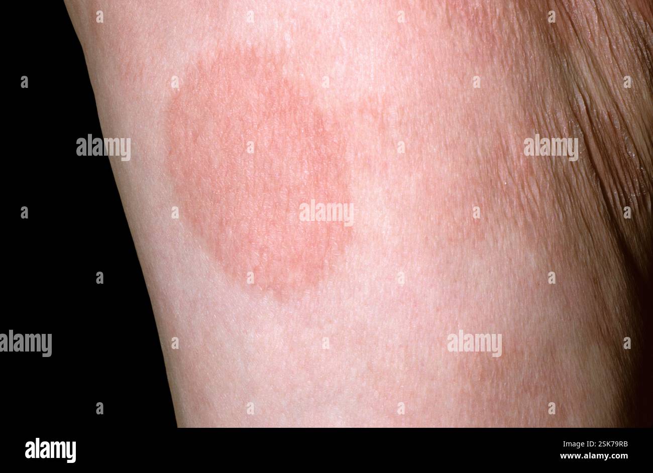 Plaque parapsoriasis. Clinical close-up view of lesions on the arm of a ...
