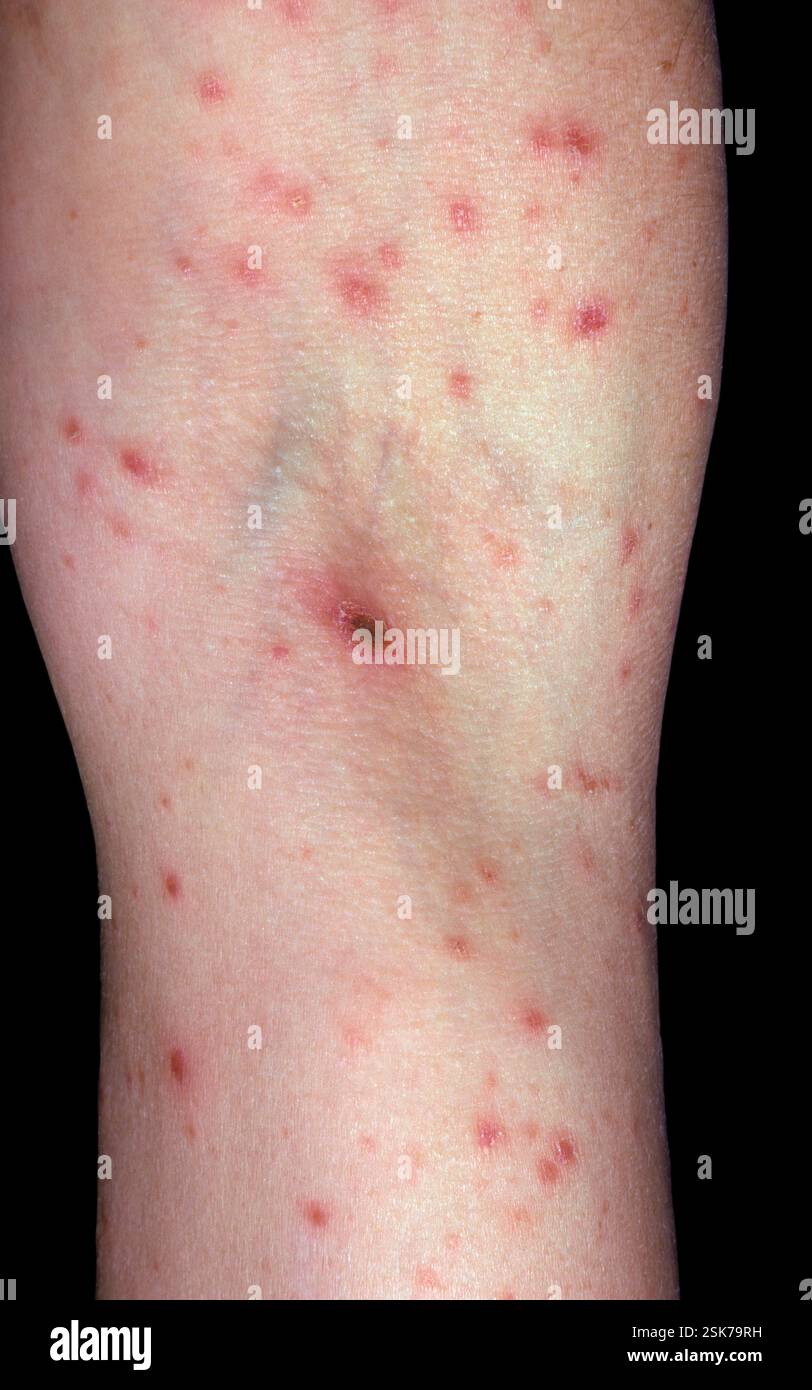 Chronic guttate parapsoriasis. Clinical view of lesions on the arm of a ...