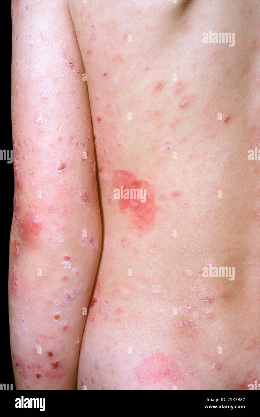 Parapsoriasis varioliformis acuta. Clinical view of lesions on the arm ...