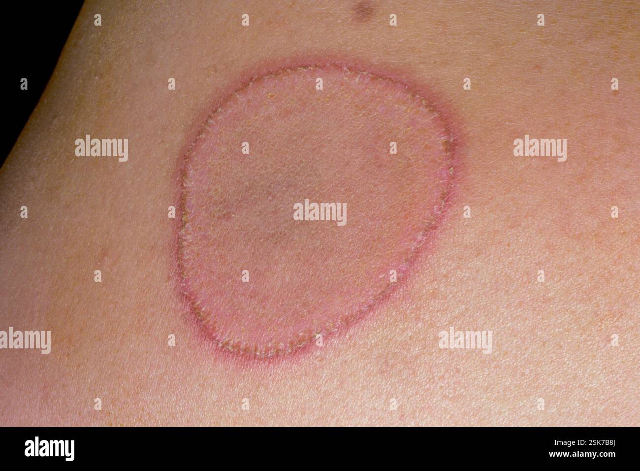 Drug-induced skin rash. Clinical view of drug-induced lesions on the ...
