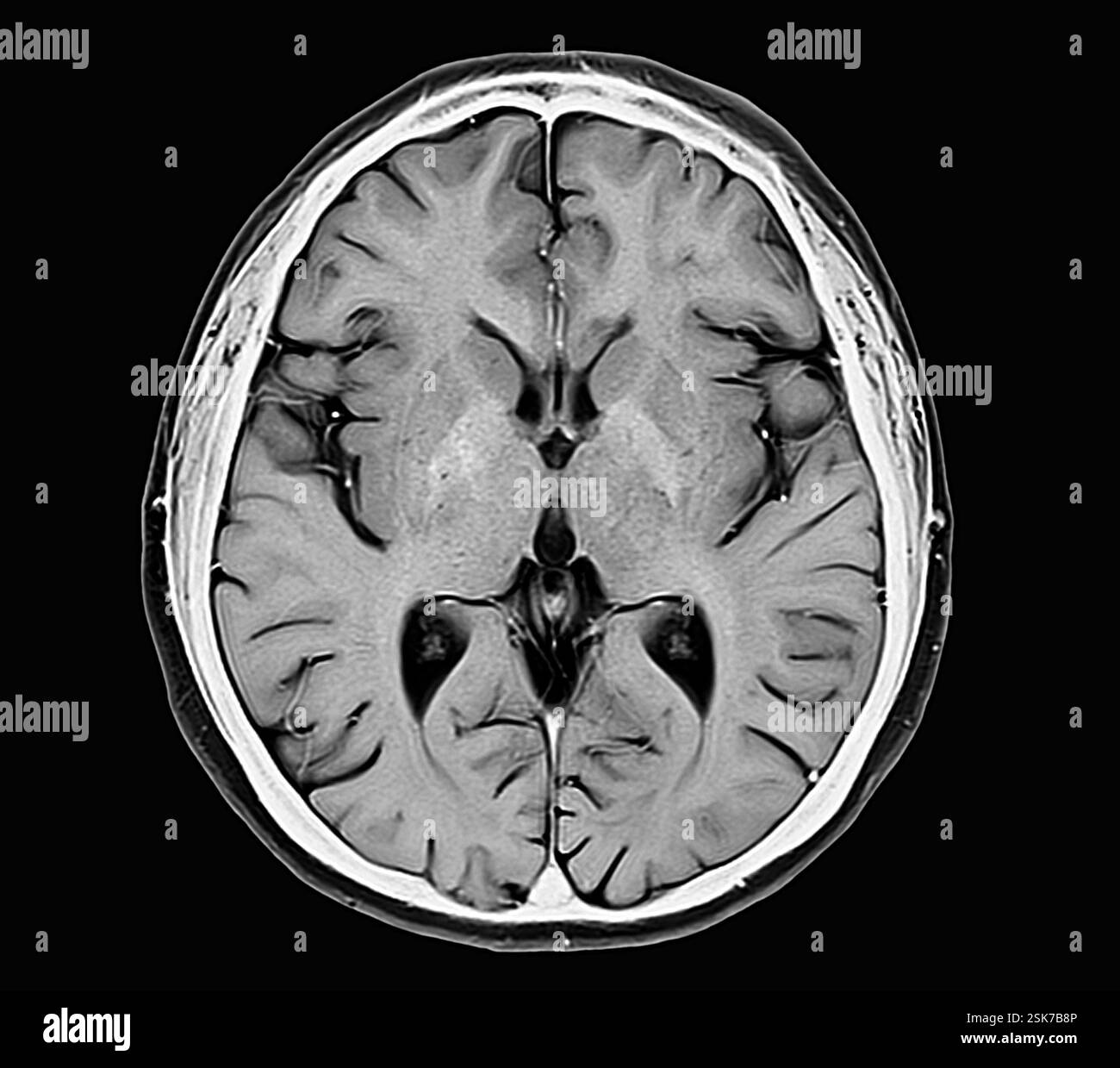 Human brain. Magnetic resonance imaging (MRI) scan of an axial section through the healthy brain ...
