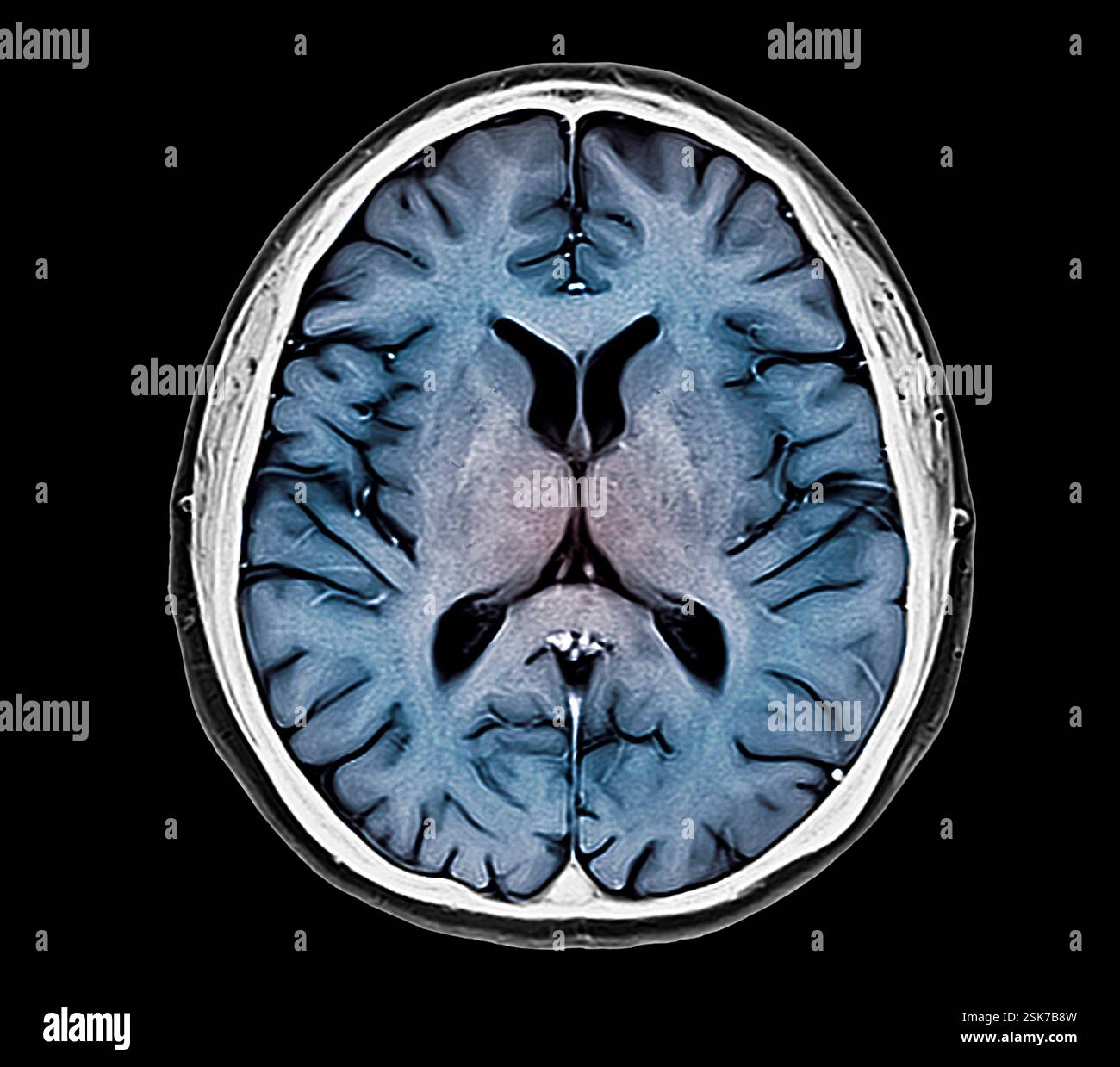 Human brain. Coloured magnetic resonance imaging (MRI) scan of an axial section through the ...