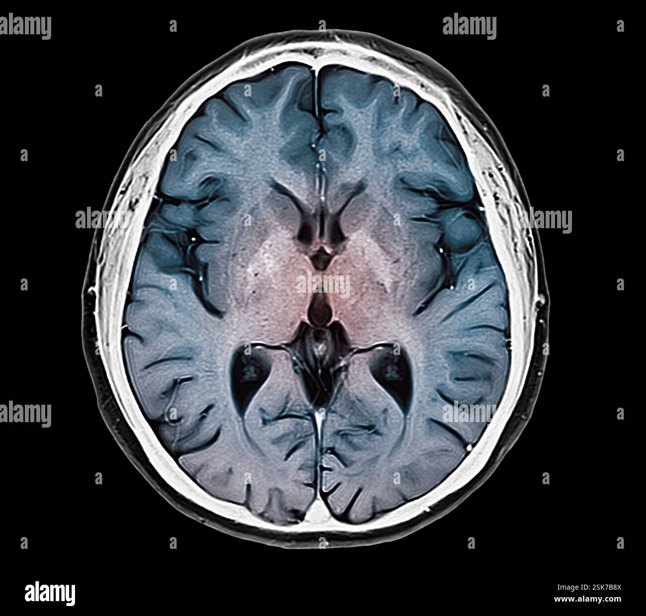 Human brain. Coloured magnetic resonance imaging (MRI) scan of an axial ...