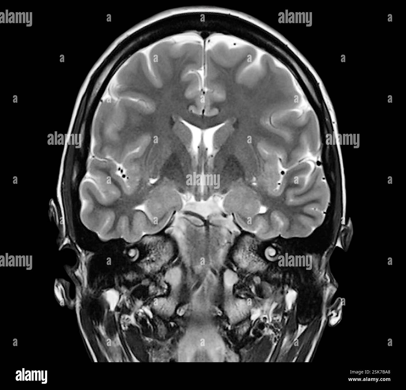 Human brain. Magnetic resonance imaging (MRI) scan of a coronal section through the head of a 30 ...