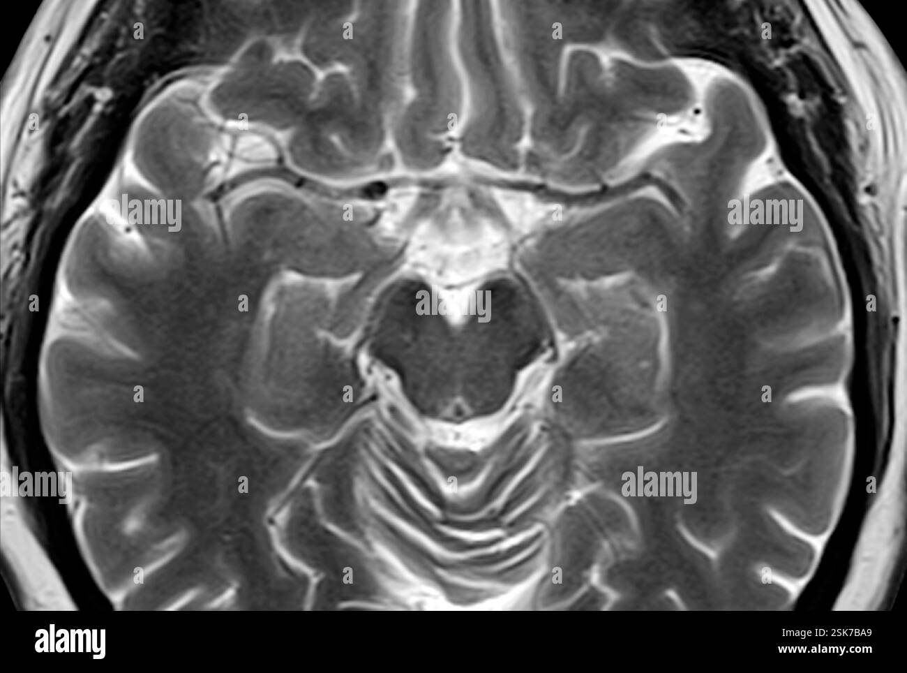 Human brain. Magnetic resonance imaging (MRI) scan of an axial section ...