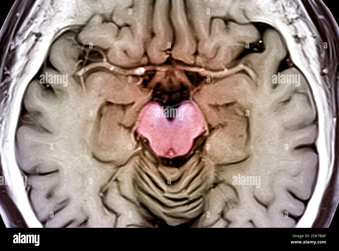 Human brain. Coloured magnetic resonance imaging (MRI) scan of an axial ...