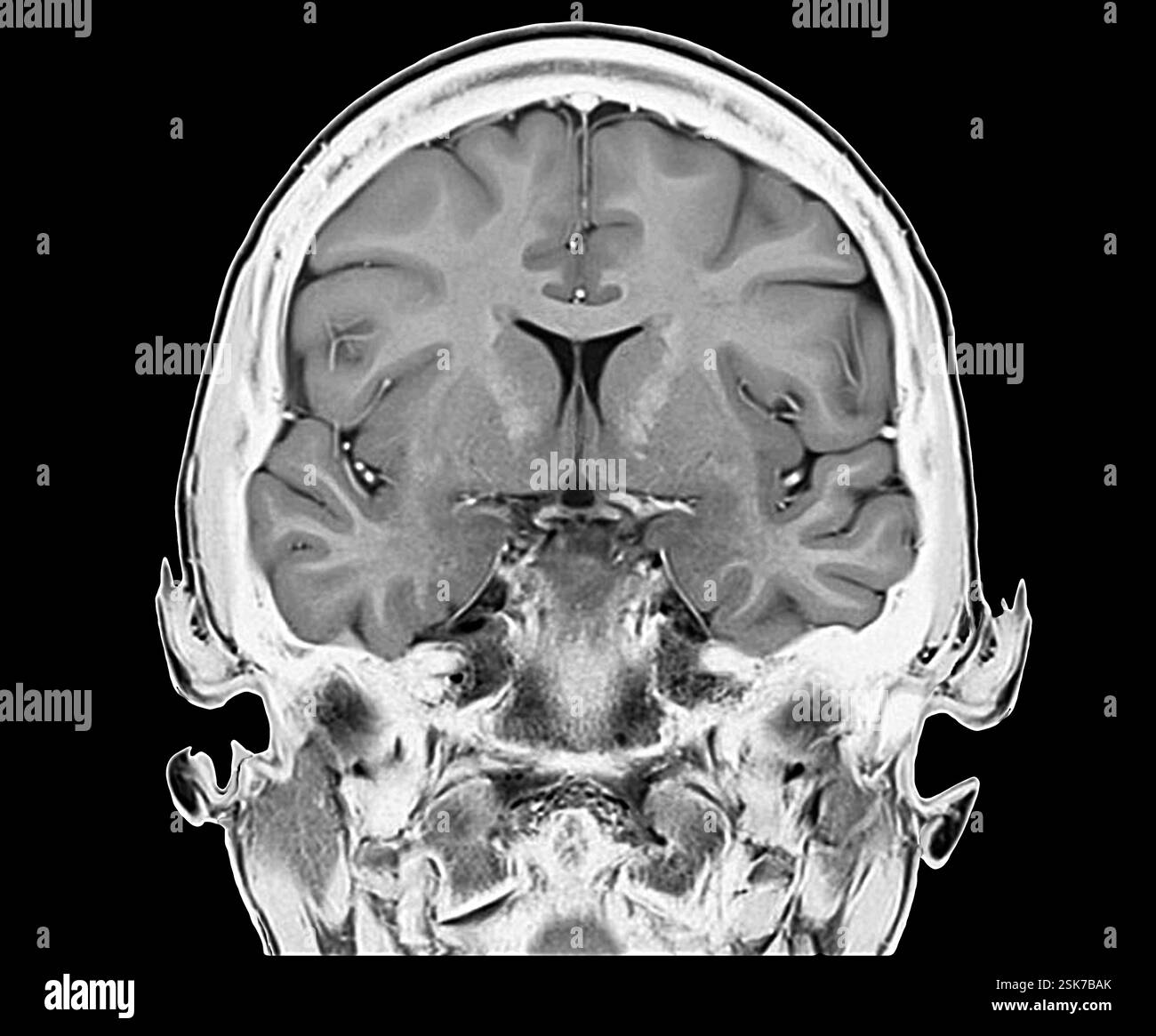 Human brain. Magnetic resonance imaging (MRI) scan of a coronal section ...