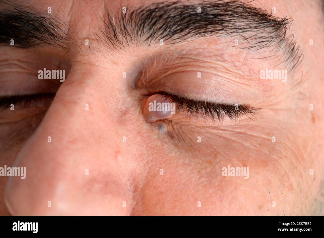 Hidrocystoma on the lower eyelid of a 64-year-old man. This condition ...