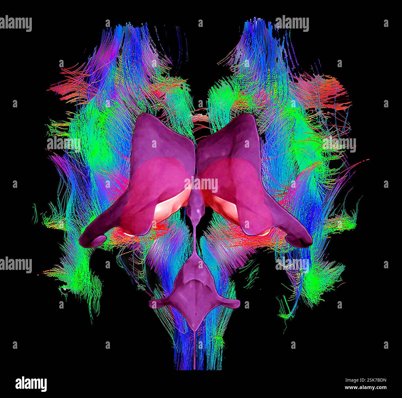 Brain fibres and structures. 3D diffusion tensor imaging (DTI) magnetic resonance imaging (MRI ...