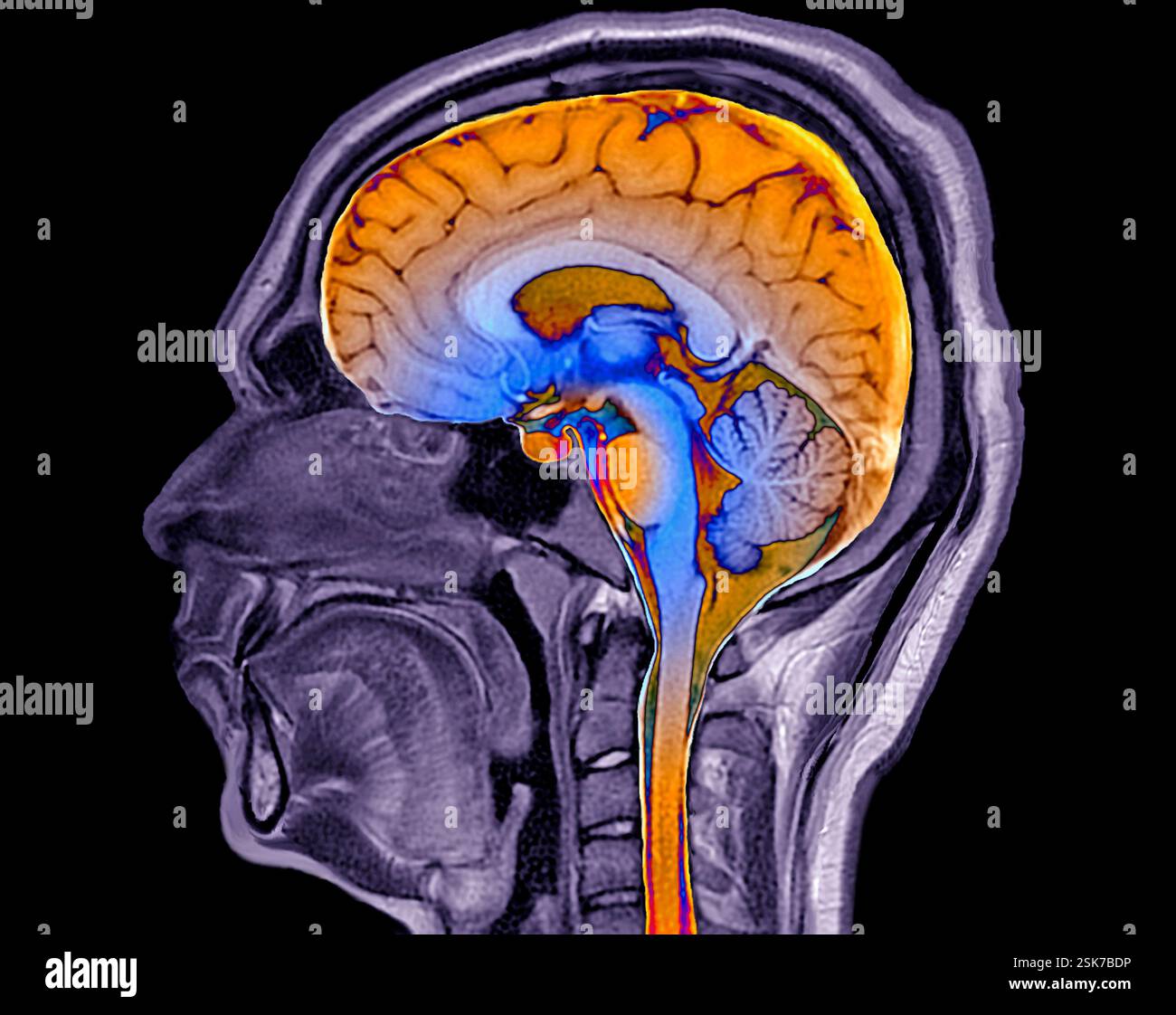 Human head and brain. Coloured sagittal magnetic resonance imaging (MRI ...
